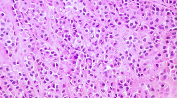Breast cancer — Science Learning Hub