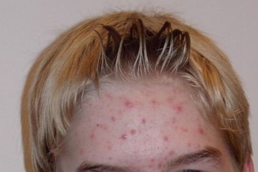 Bioactive milk proteins attack acne — Science Learning Hub